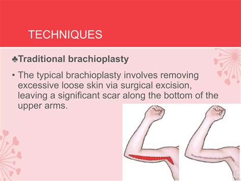 Brachioplasty Ppt