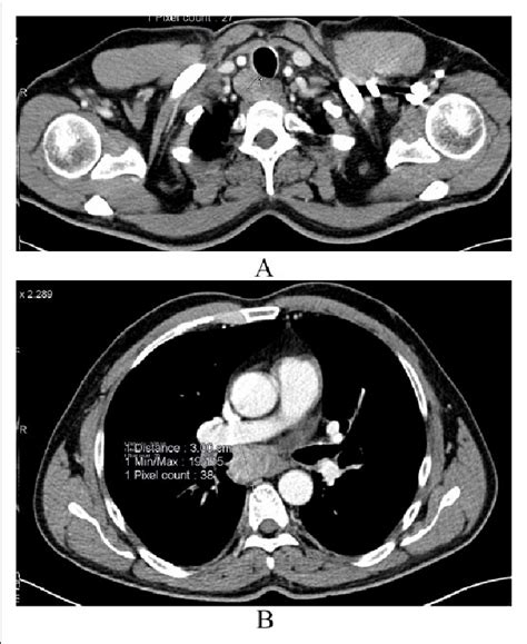 Baseline Computed Tomography Scan October 2013 Showing A Right