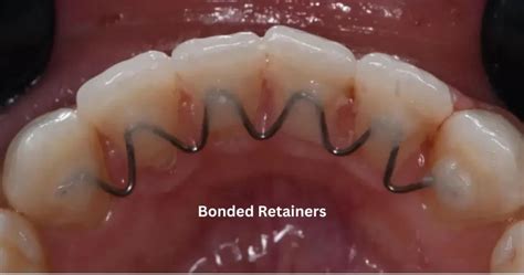 Bonded Retainer
