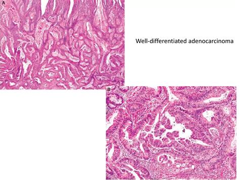 Serrated Pathway To Colorectal Neoplasia Ppt