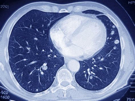 Medicare Poised To Cover Ct Scans To Screen For Lung Cancer Shots Health News Npr
