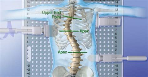 Spinal Technology The Providence Nocturnal Scoliosis® System