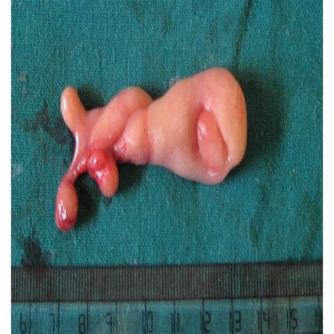 A T2 Weighted Mri Sagittal Image Showing The Tonsillar Polyp With The