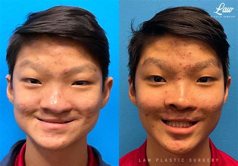 Plastic Surgery Before And After Face Plastic Surgery Disasters