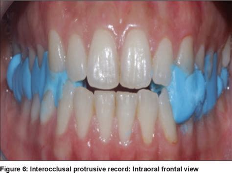 Figure 6 From Comparison Of Sagittal Condylar Guidance Angle Obtained