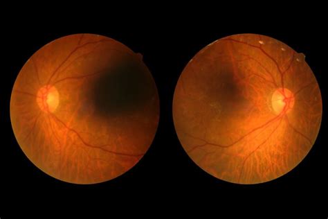Diabetic Eye Disease Ophthalmology Clinic In Dubai Drhc