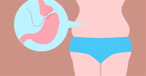 Gastroparesis Life Expectancy What You Need To Know