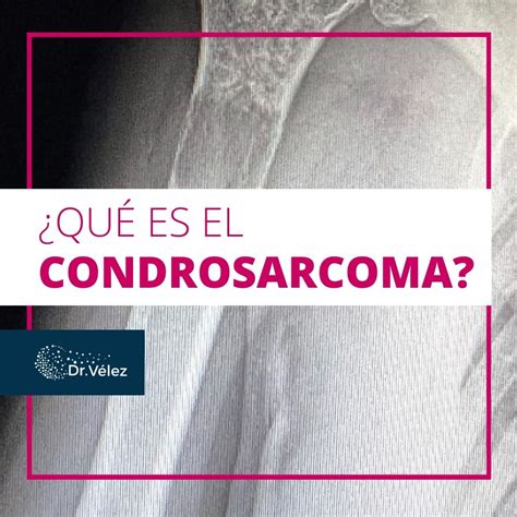 Condrosarcoma Dr Roberto