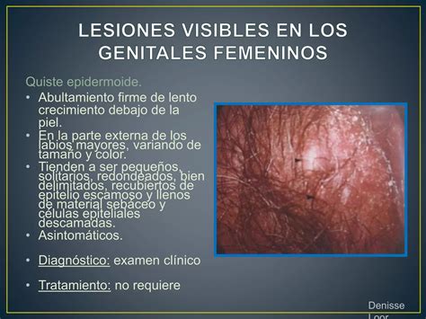 Lesiones Visibles En Los Genitales Femeninos Pptx