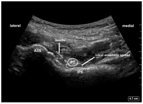 Jpm Free Full Text Pericapsular Nerve Group Peng Block Versus