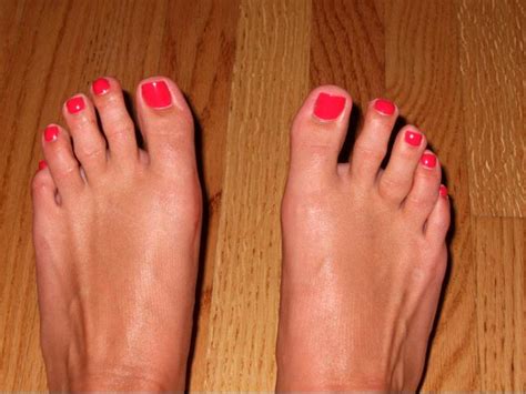 Big Toe Shortening Surgery
