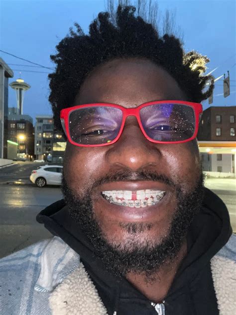 Class Iii Underbite No Extraction No Jaw Surgery Braces