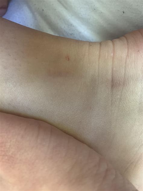Hey I Had Scabies For Several Months And A Lot Of Different Treatments