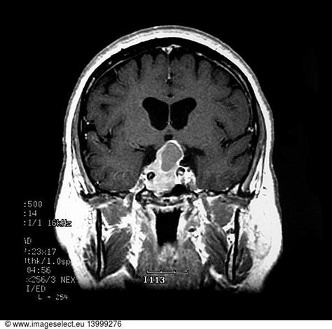 Mri Of Pituitary Macroadenoma Mri Of Pituitary Macroadenomaimagingenlargement Of Sella Turcica