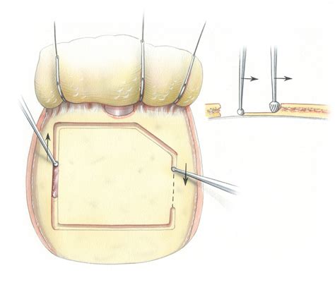 Middle Fossa Approach To The Internal Auditory Canal Skull Base Surgery Atlas