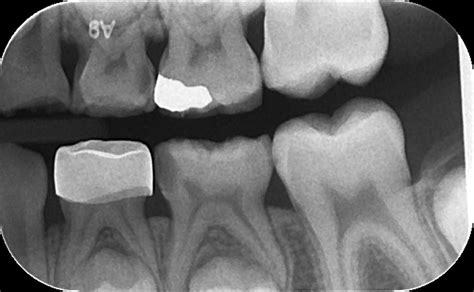 X Ray Of Interproximal Caries Era