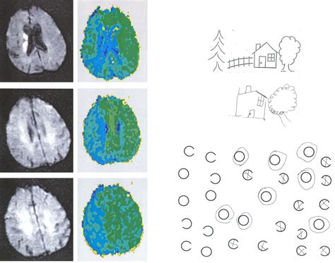 Anatomy Of Spatial Attention Insights From Perfusion Imaging And Hemispatial Neglect In Acute