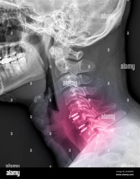 Projection X Ray Of Cervical Spine Showing Anterior Cervical Discectomy