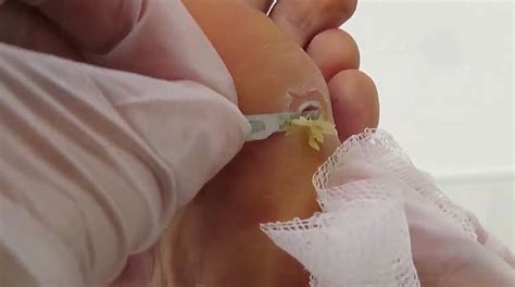 Grim Footage Shows Miss Foot Fixer Popping A Spot On The Sole Of A