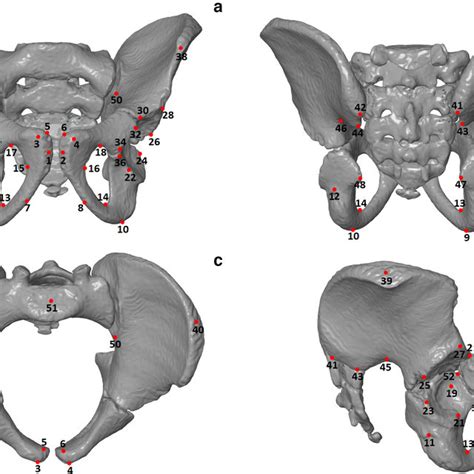 Aitken Classification Of Congenital Femoral Deficiency Download Scientific Diagram