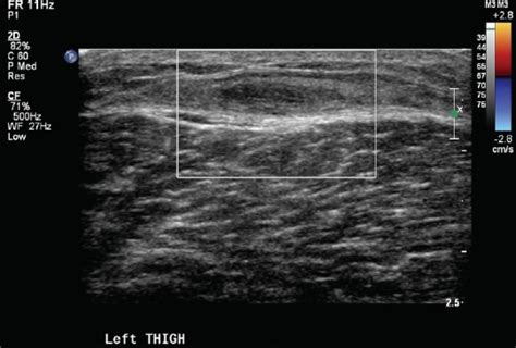 Soft Tissue Sarcoma Masquerading As A Haematoma Pmc