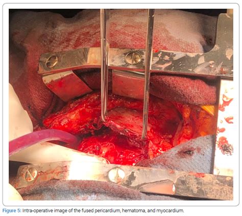 Left Ventricular Dissecting Pseudoaneurysm With Extensive Intramural Course Diagnostic