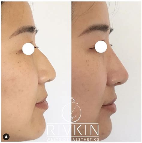 Non Surgical Nose Job Nose Job Nose Fillers Nonsurgical Nose Job