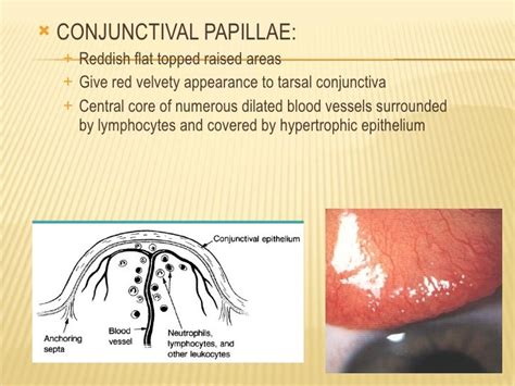 Follicles Vs Papillae Papillae Vs Follicular Conjunctivitis Obecw