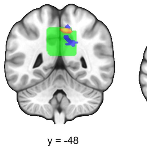 Voxel‐wise Regression Analysis Rendered On Mni152 Standard Brain