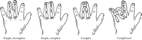 Congenital Hand Surgery Plastic Surgery Keyplastic Surgery Key