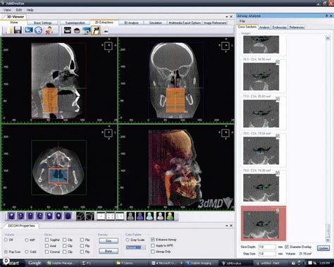 Velopharyngeal Dysfunction Plastic Surgery Key