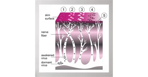Diagram Of The Progression Of Shingles On Skin Poster Zazzle