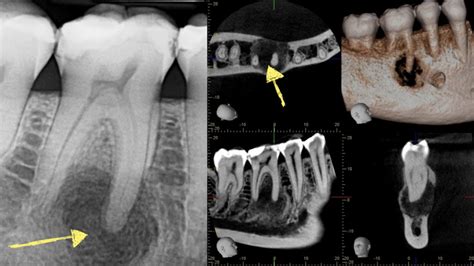 Periapical Abscess Radiograph