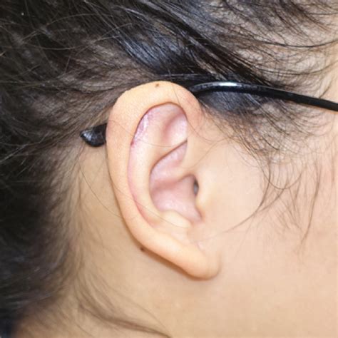 Keloid Piercing Cartilage