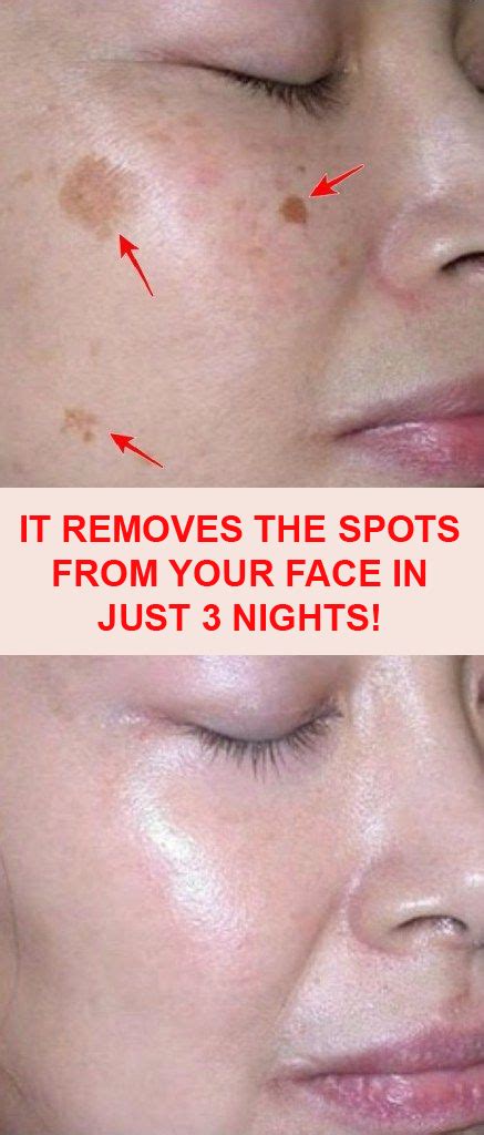 IT REMOVES THE SPOTS FROM YOUR FACE IN JUST 3 NIGHTS Health DIY And Crafts