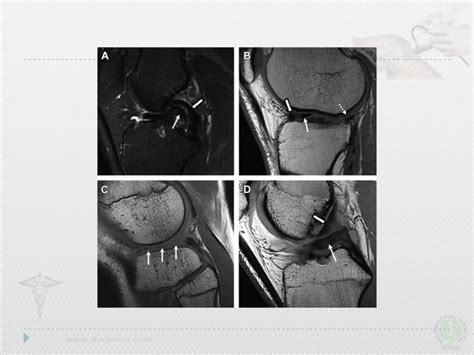 Meniscus Repair Vs Meniscectomy