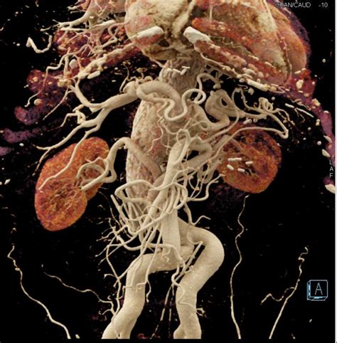 Bypass Grafting To The Superior Mesenteric Artery Sma Vascular Case