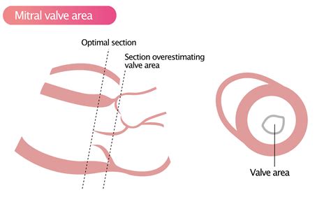 Mitral Valve Stenosis Echocardiography Diagnosis Causes Severity