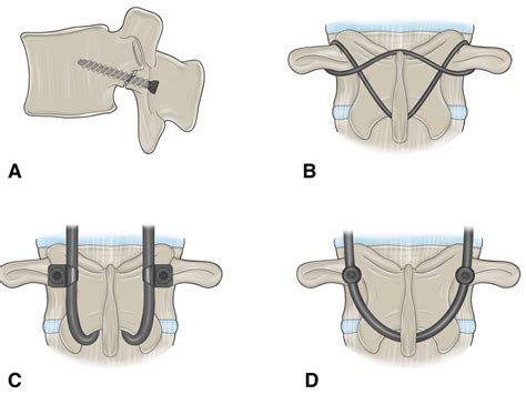 Pars Interarticularis Fractures Treated With Minimally Invasive Surgery