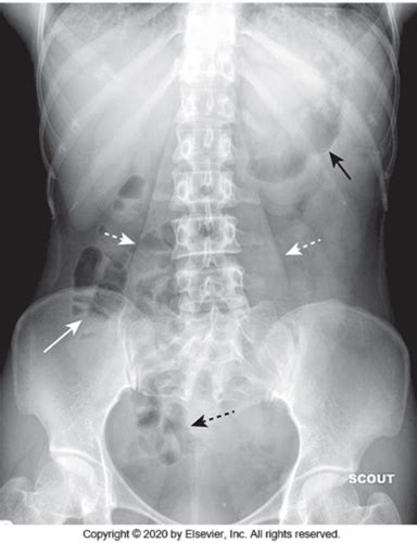 Normal And Abnormal Gas Patterns Flashcards Quizlet