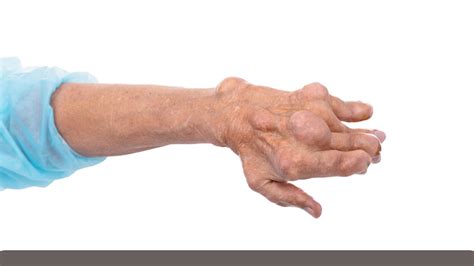 What Is Polyarthritis Klarity Health Library What Is Polyarthritis Klarity Health Library