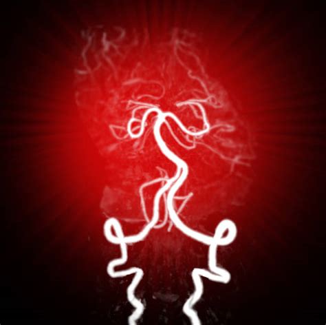 250개 이상의 출혈성 뇌졸중 이미지 스톡 사진 그림 및 Royalty Free 이미지 Istock