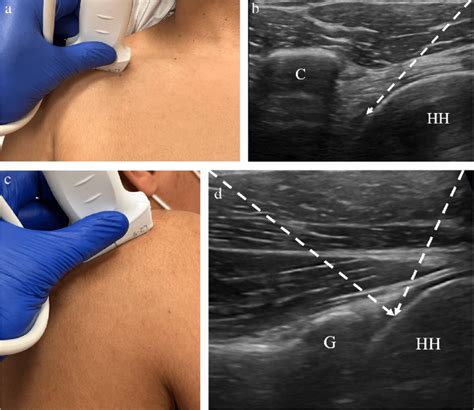 Intraarticular Shoulder Injection Injections Were