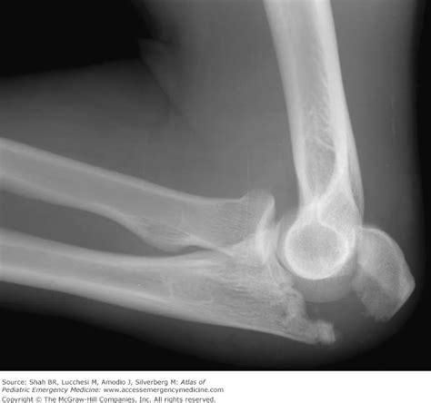 Olecranon Fractures Core Em