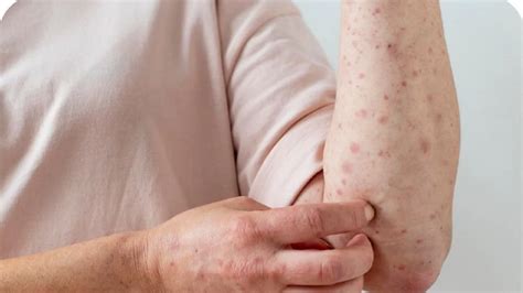 آیا می شود برای بار دوم آبله مرغان گرفت