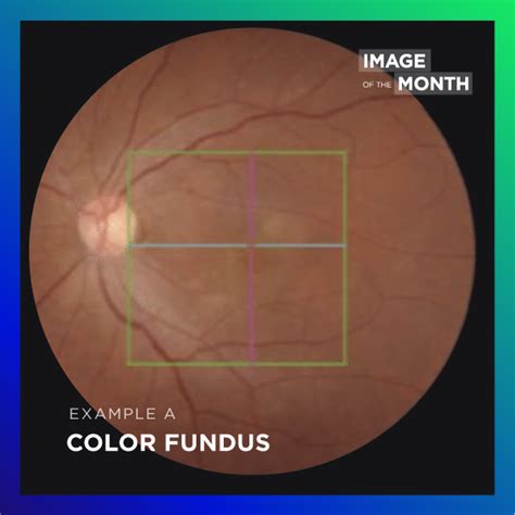 Suprachoroidal Iluvien® Implant For Treatment Of Diabetic Macular Edema