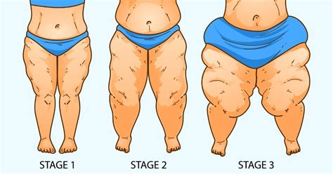Lipedema ¿qué Es Y Cuáles Son Sus Síntomas El Financiero