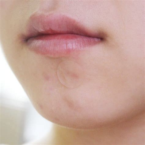 여드름패치추천 빠질 수 없는 메디폼 네이버 블로그