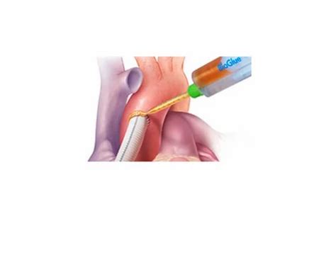 Bio Glue At Best Price In Chennai Id 2852174474688