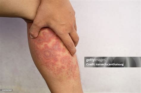 Acute Atopic Dermatitis On The Legs A Red Inflamed Scaly Rash On The